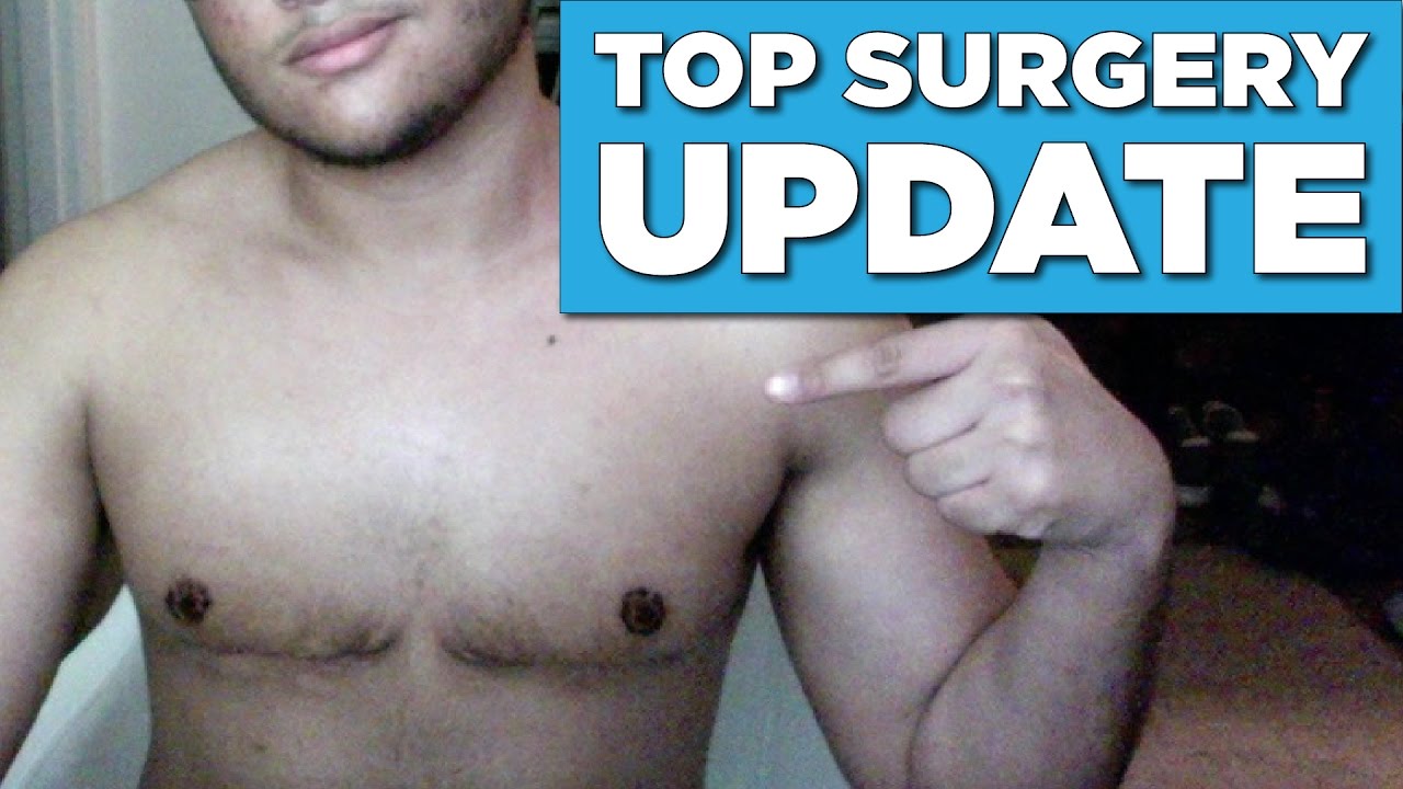 Top Surgery Update Youtube