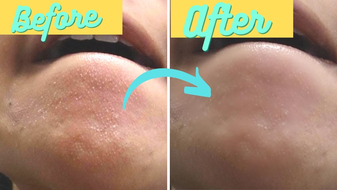 How To Remove Whiteheads And Blackheads From Chin At Home YouTube how-to-remove-whiteheads-and-blackheads-from-chin-at-home-youtube