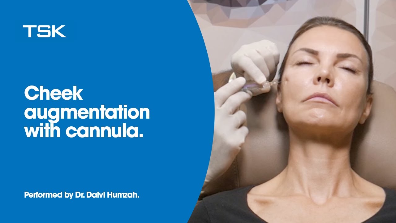 Dermal filler cheek augmentation using STERiGLIDE cannula - YouTube