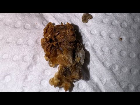 HUGE Cerumen Plug Causing Ear Canal Obstruction - YouTube