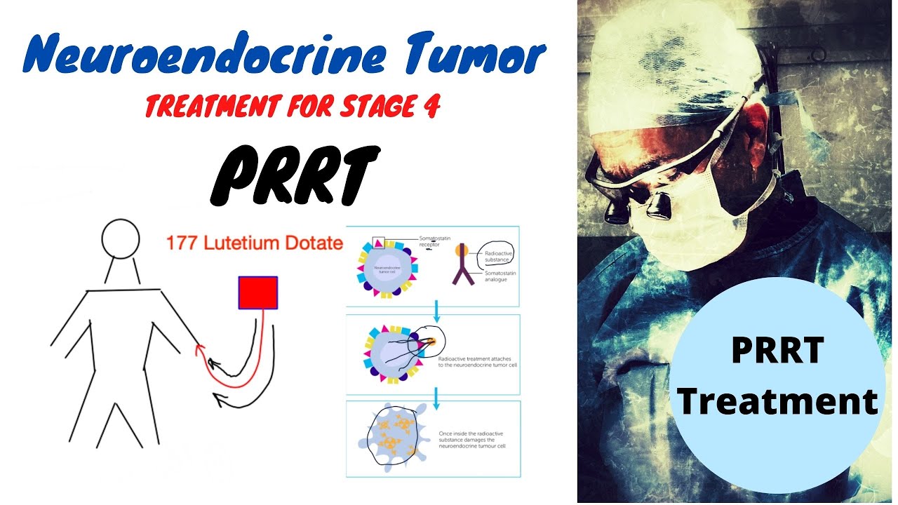 PRRT Treatment Neuroendocrine Tumors - YouTube