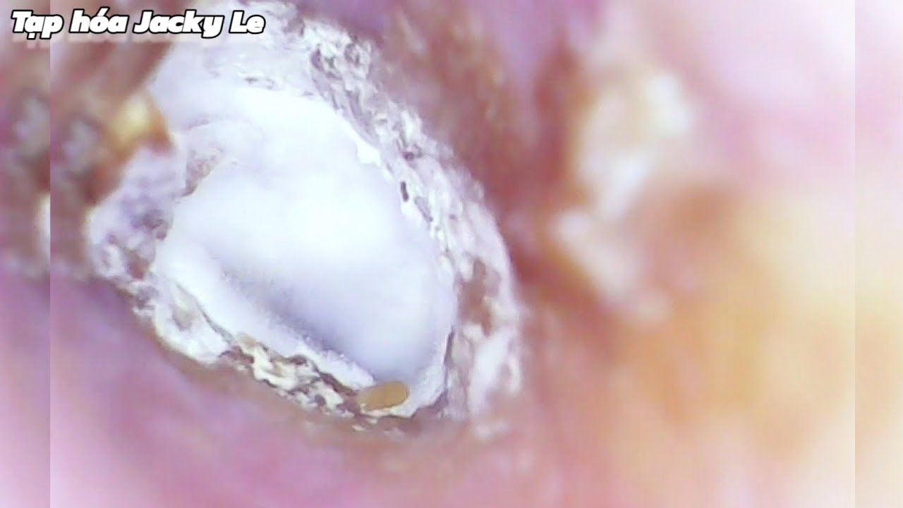 Ear Wax Removal # 127: His Earwax Is Infected With White Yeast | Ear ...
