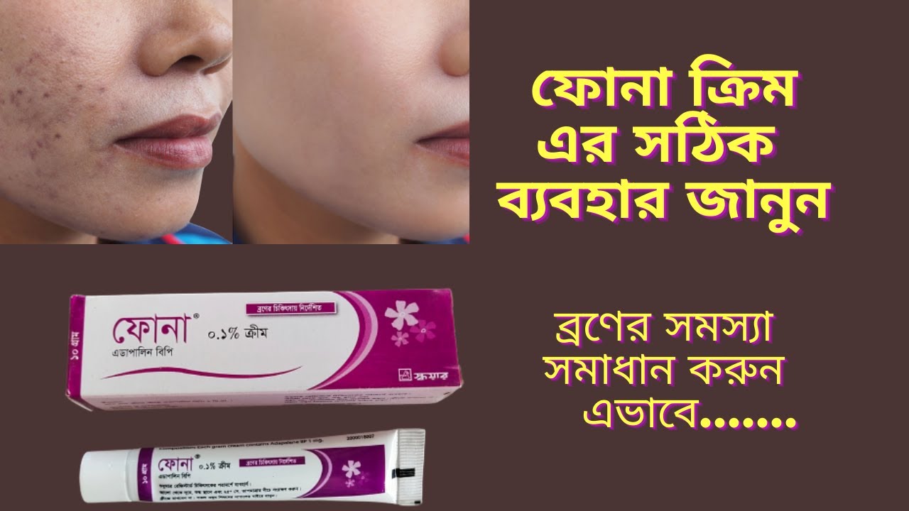 Fona Cream || ব্রণথেকে চিরমুক্তির সহজ উপায় || Osud Potro - YouTube