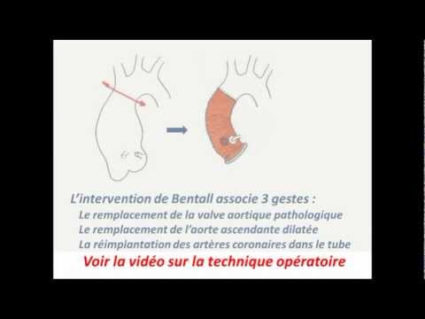 L'intervention de Bentall en 1 minute - YouTube