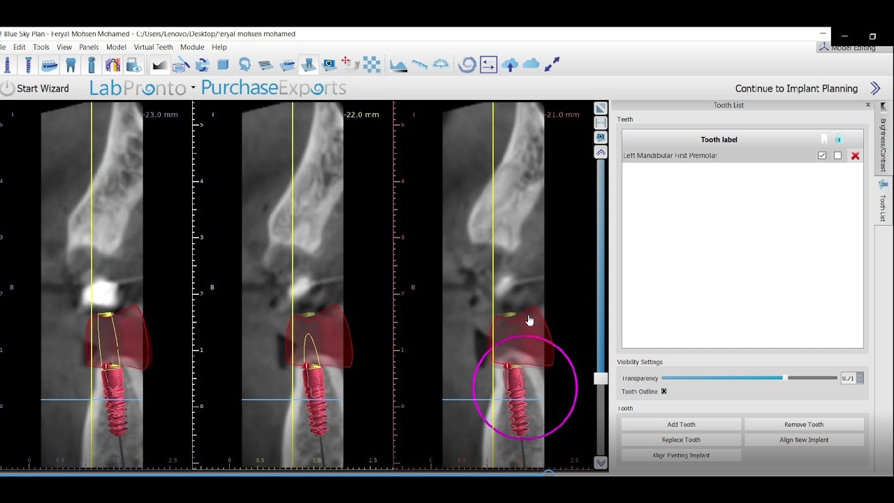 CBCT planning for dental implant - YouTube