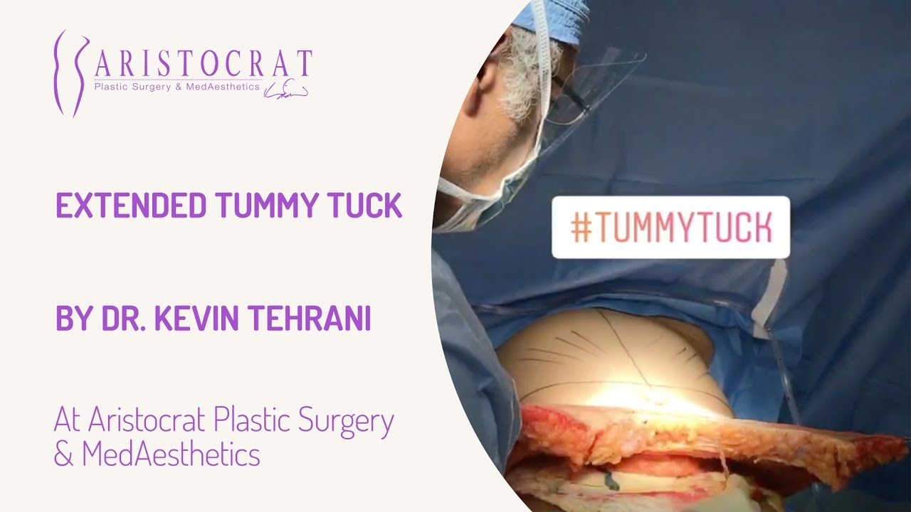 Extended Tummy Tuck Long Island, New York by Dr. Kevin Tehrani - YouTube