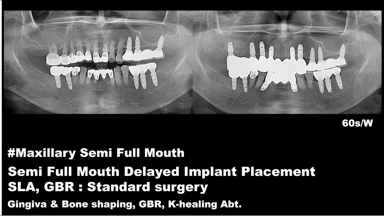 [Dental implant] #Maxillary Semi Full Mouth Delayed Implant Placement ...