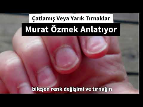 Tırnakta Çukurlar ne anlama geliyor Çentikli Çukurlaşmış Noktalı Tırnaklar hangi hastalık belitisi