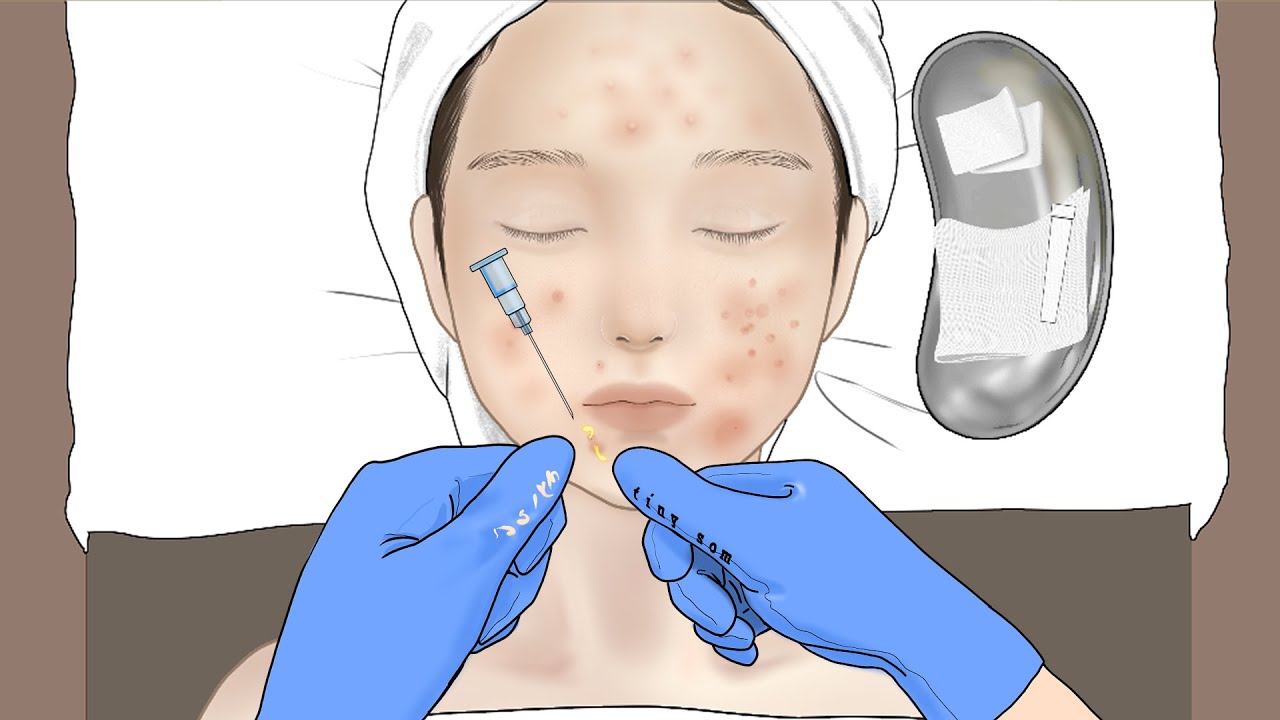 [ASMR] 팅글 1000%💥 여드름 압출과 피부관리를 한번에! / Acne extract / makeup animation ...