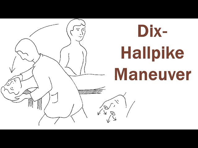 Dix Hallpike Maneuver Illustration BPPV - Benign Paroxysmal