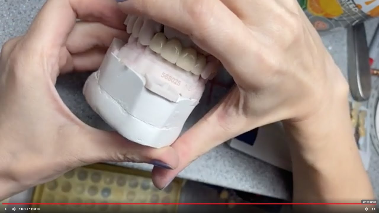 Anterior PFM Bridge Buildup - Start to Finish - YouTube