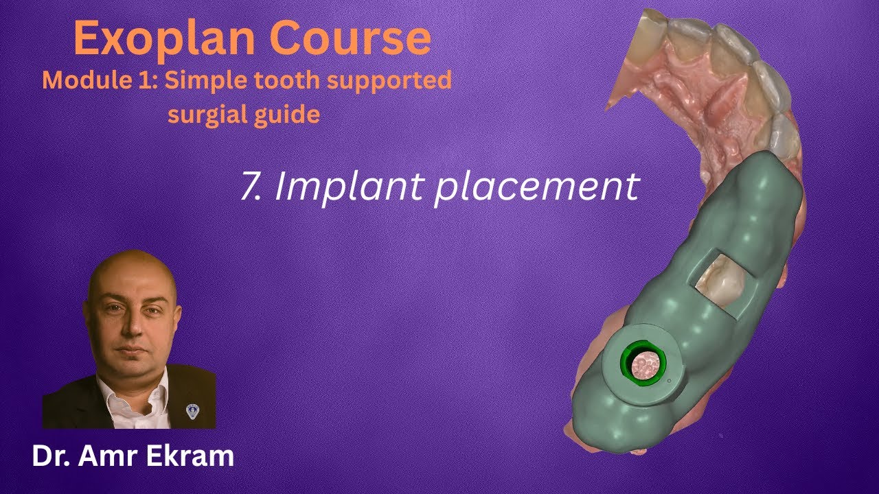 7 Implant placement in Exoplan - YouTube
