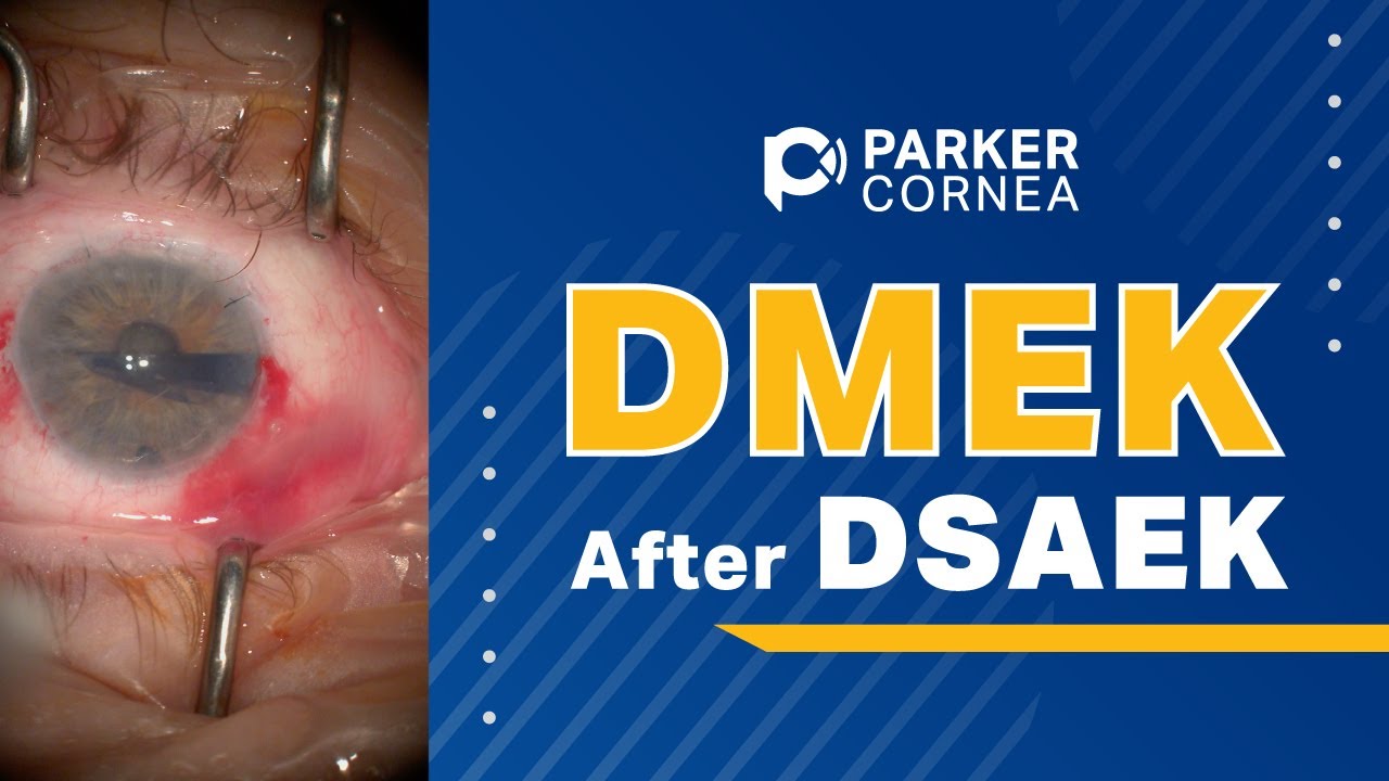 DMEK After DSAEK - YouTube