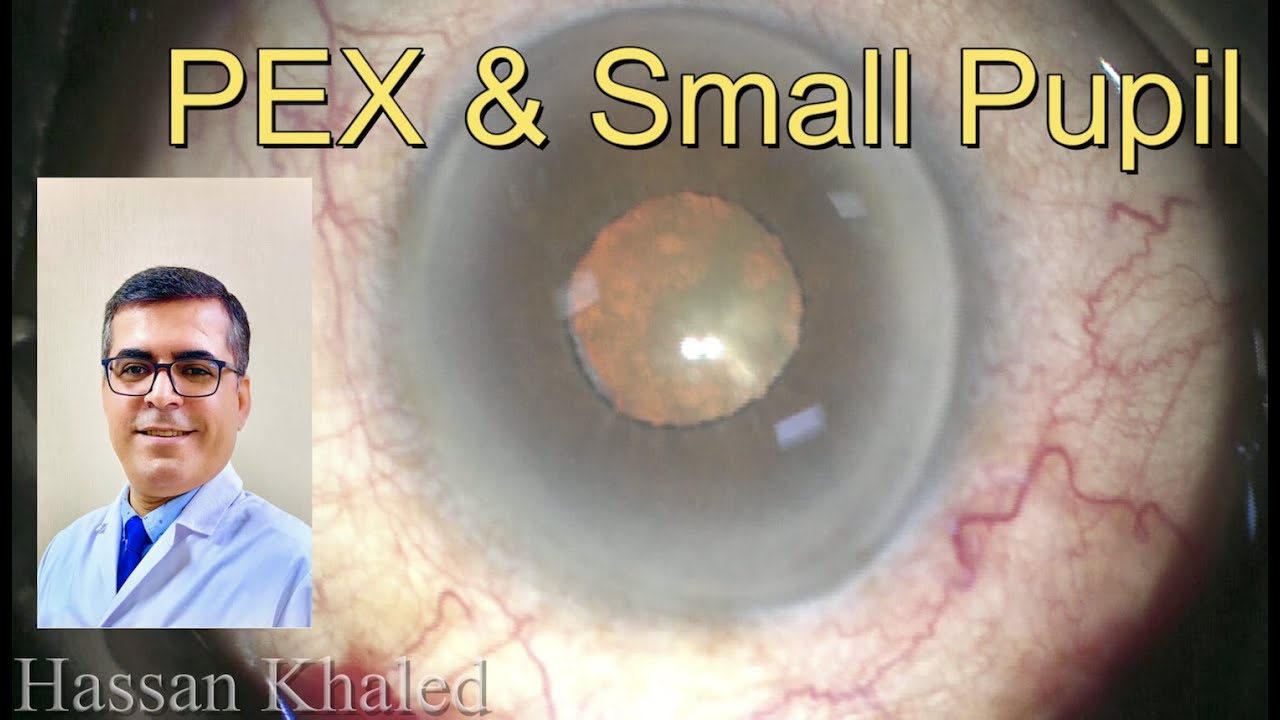 Phacoemulsification of Dense Cataract with PEX and Small Pupil - YouTube