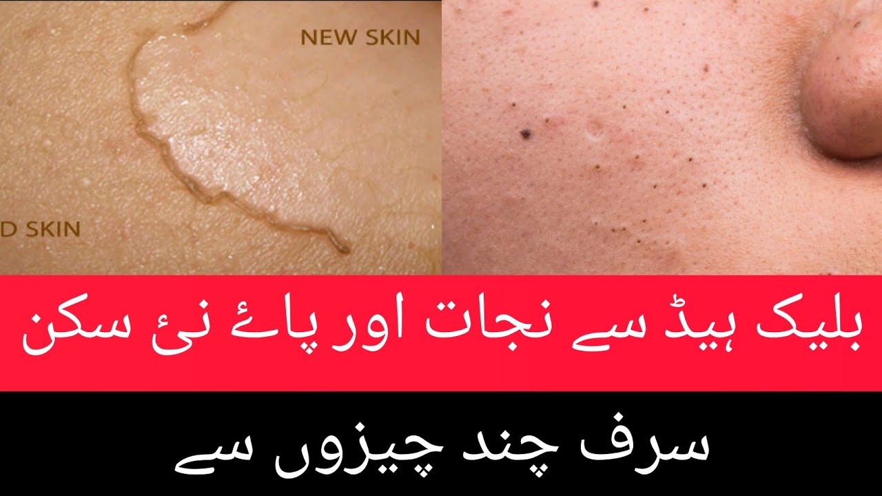 How To Remove Black Heads And Dead Skin Cells Over Night YouTube how-to-remove-black-heads-and-dead-skin-cells-over-night-youtube