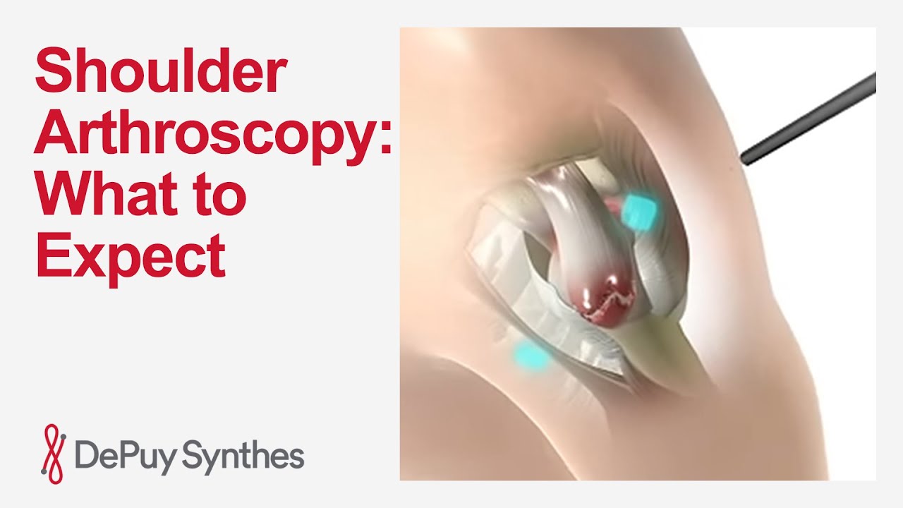Shoulder Arthroscopy Surgery: Preparation, Procedure & Recovery ...