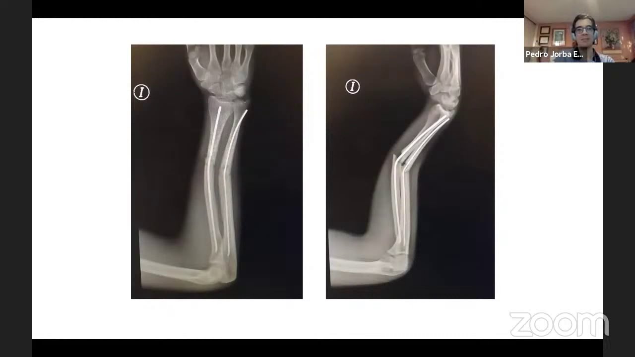 WEB29 - Fracturas del Antebrazo - Paciente Pediátrico - YouTube