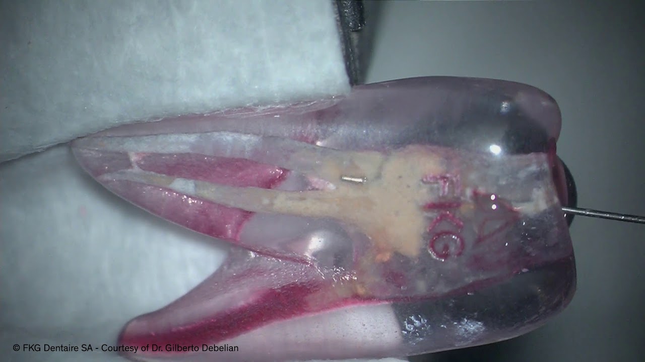 FKG XP-endo Solutions - Retreatment simulation in a FKG-3D Tooth - YouTube