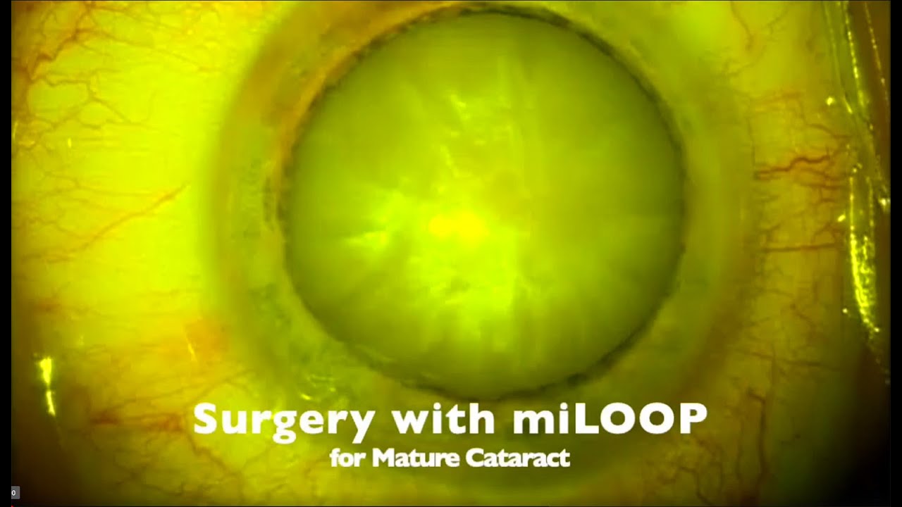 miLoop used in a cataract procedure - YouTube
