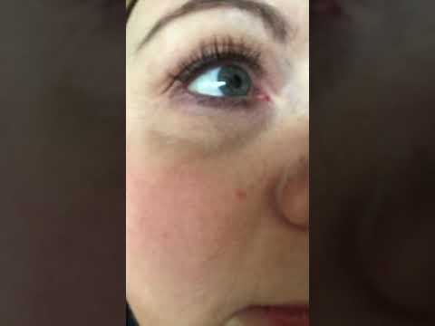 Lower eyelid myokymia - YouTube
