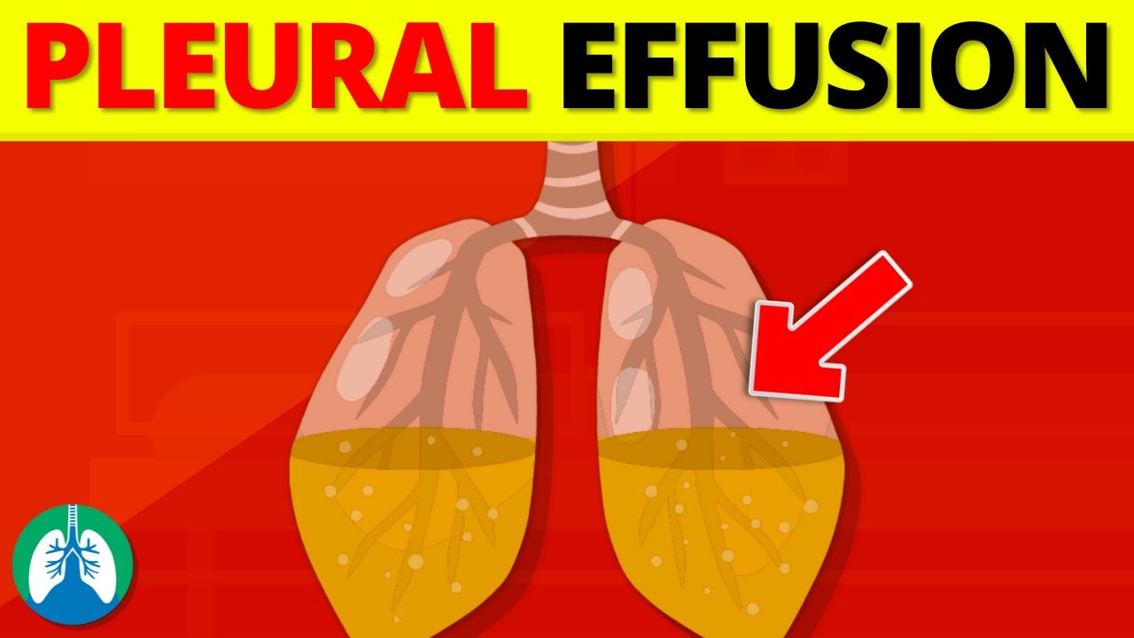 Pleural Effusion (Medical Definition) | Quick Explainer Video - YouTube