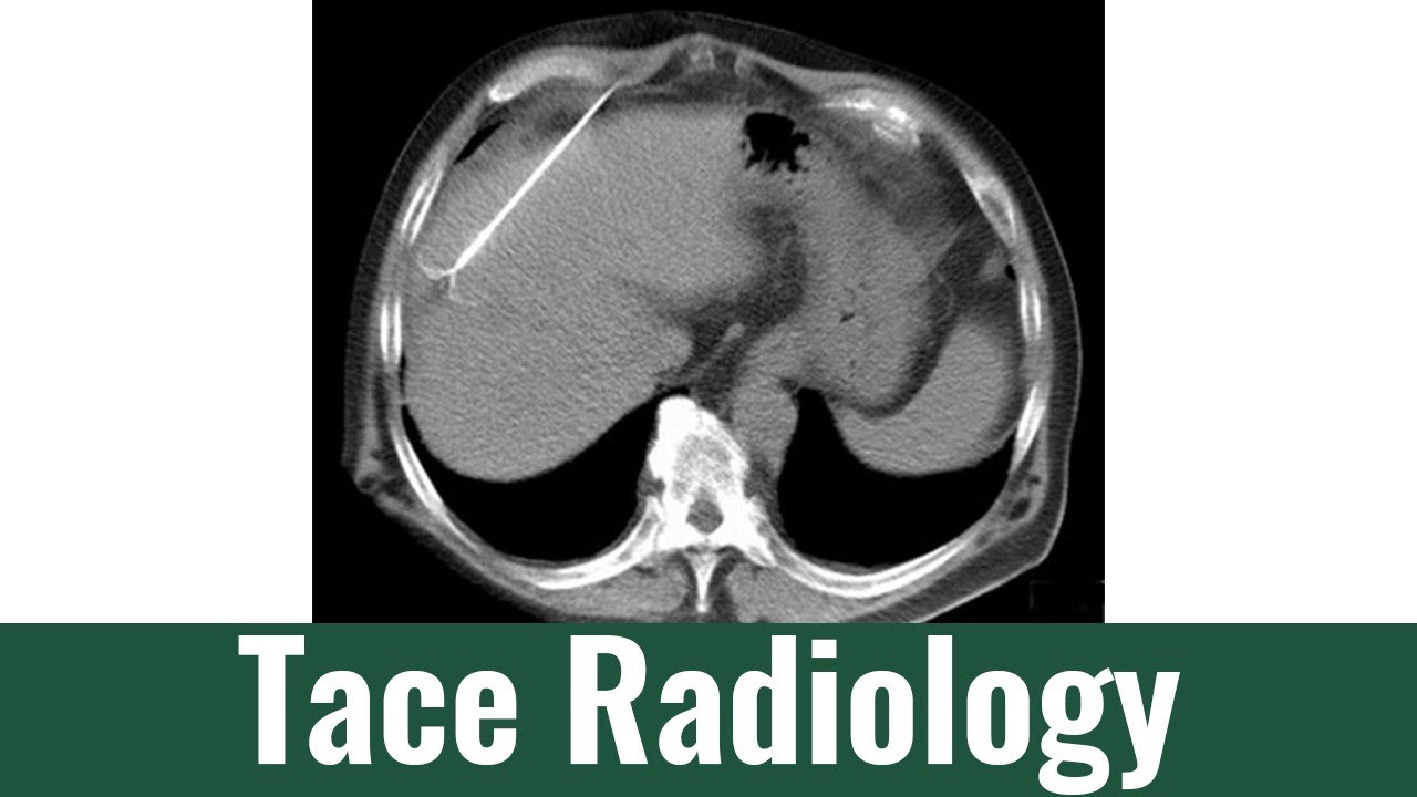Transarterial Chemoembolization (TACE) Therapy & Procedure: Hepatic ...