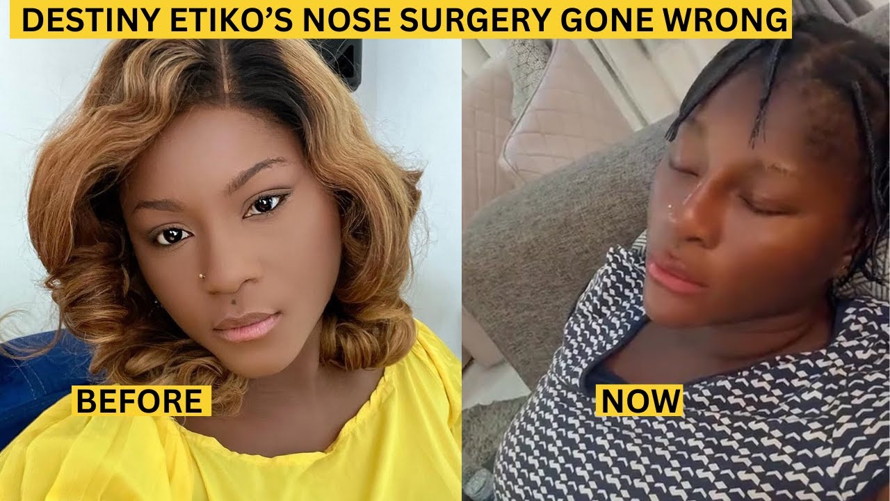"Destiny Etiko's Nose Surgery : Shocking Before and After!" - YouTube
