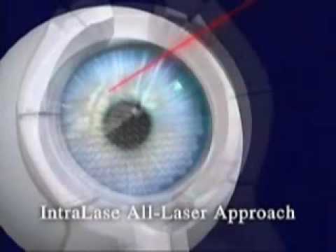 Hawaii Lasik Surgery Using Intralase® Laser Technology - YouTube