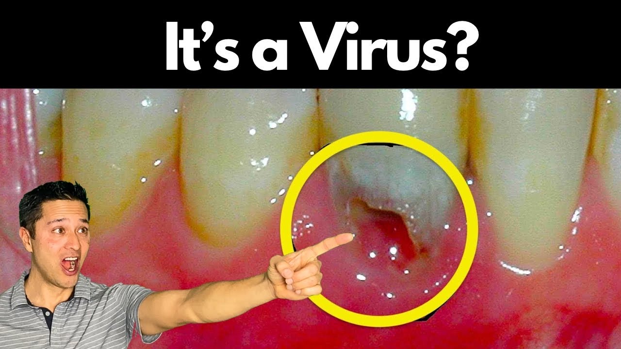 External Root Resorption Treatment OPTIONS w/ Dr. Nasseh - YouTube