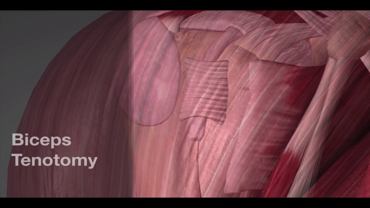 Long Head of Biceps Tenotomy - YouTube
