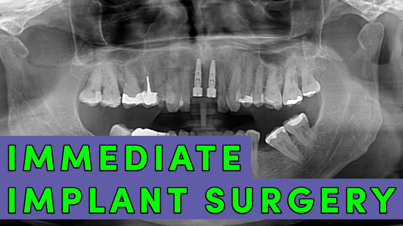 Front Teeth Removal and Guided Implant Placement Surgery - YouTube
