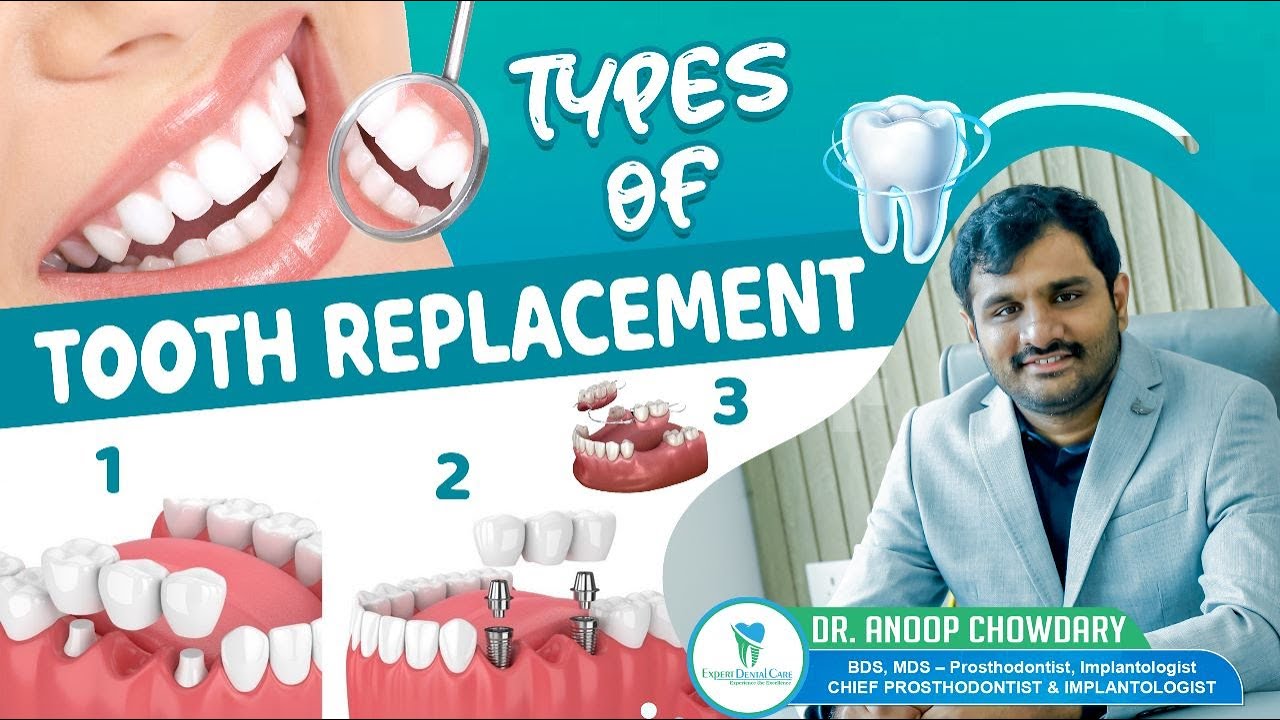 Types Of Tooth Replacement Available | Teeth Replacement || Dr. Anoop ...