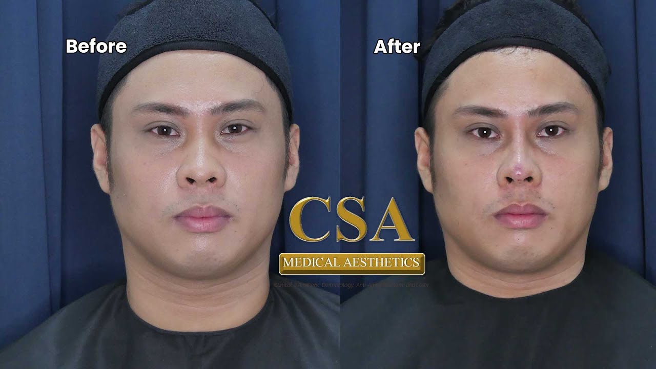 IMPROVING THE ANGLES OF THE NOSE: FOR A MORE AESTHETICALLY APPEALING ...