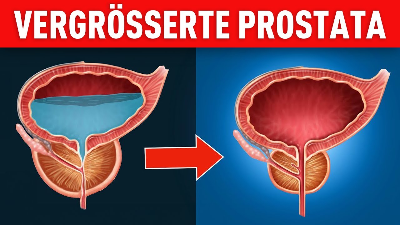 Die 5 BESTEN Lebensmittel bei vergrößerter Prostata! - YouTube