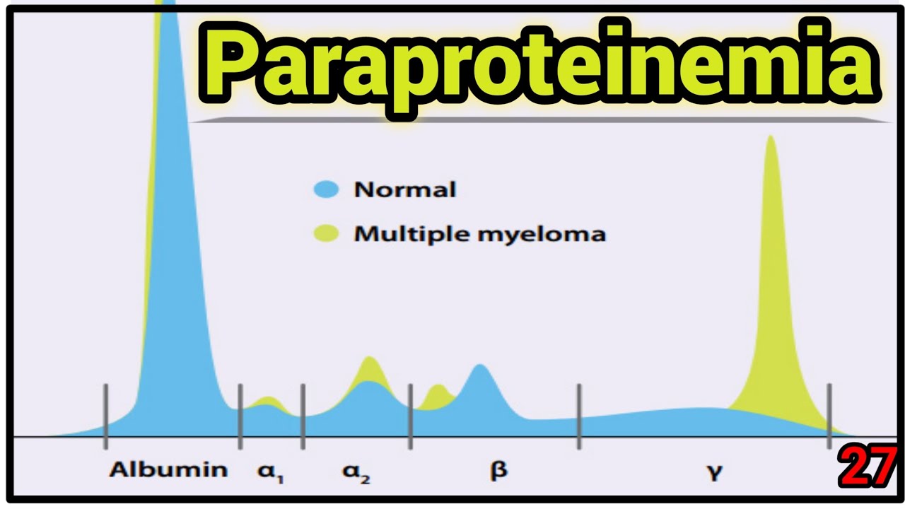 Blood || Paraproteinemia & Multiple Myeloma || Lecture 27 - YouTube