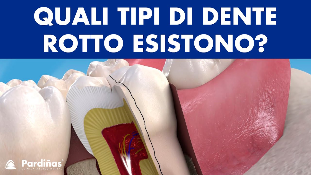 DENTE SCHEGGIATO e spezzato - Quali tipi di DENTE ROTTO esistono ...