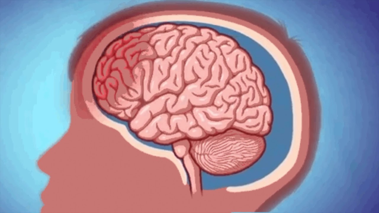 Concussed: Video for Engaging the Compromised Brain - YouTube