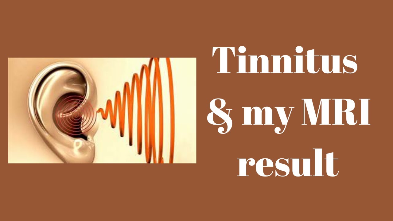 Tinnitus Update and my MRI result - YouTube