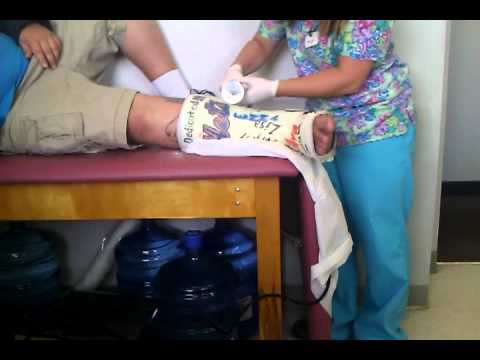 Cutting my cast off - YouTube