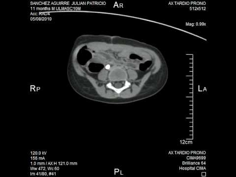 UroTac 1Paquetin - YouTube
