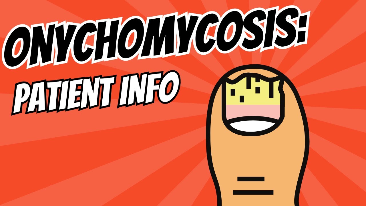 Onychomycosis patient information - YouTube