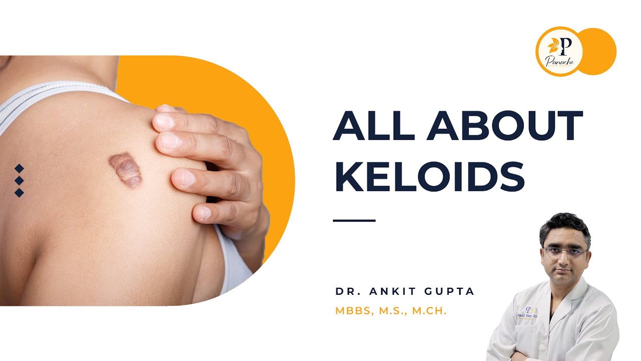 What are Keloids | Why do they occur? | How to avoid Keloid? | Symptoms ...