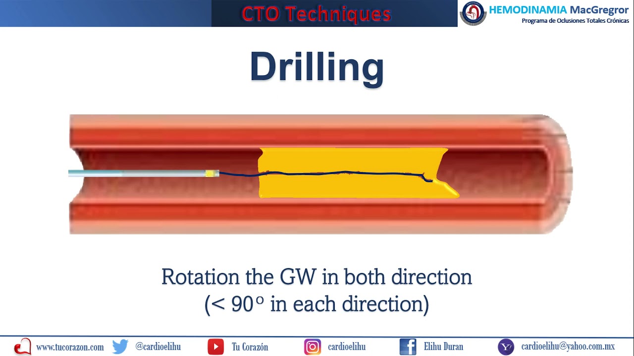Técnicas en CTO: Guide wire displacement techniques - YouTube