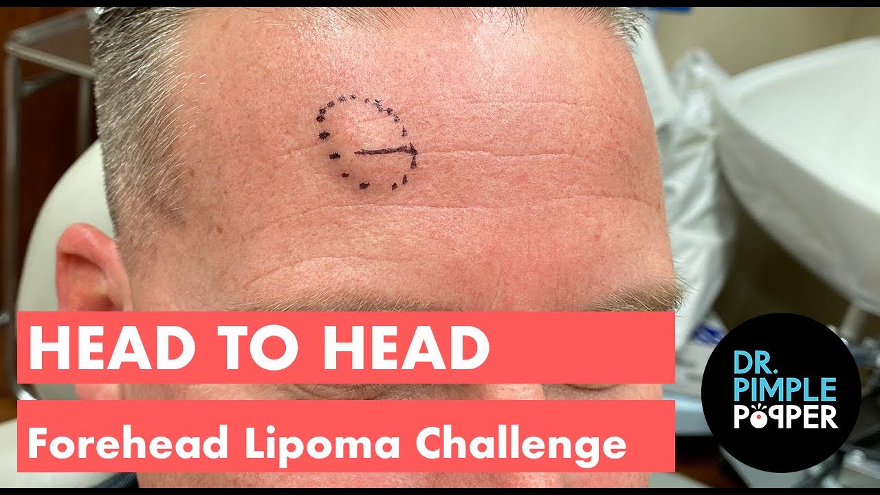 Head to Head: Forehead Lipoma Challenger 1 - YouTube