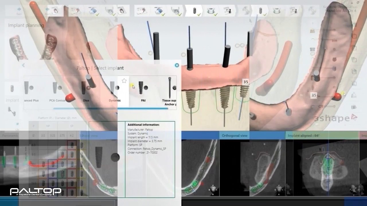 All-on-4 Planning for the Paltop Implant System - YouTube