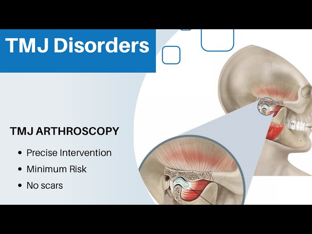 Arthroscopic Temporomandibular Joint Tmj Dysfunction