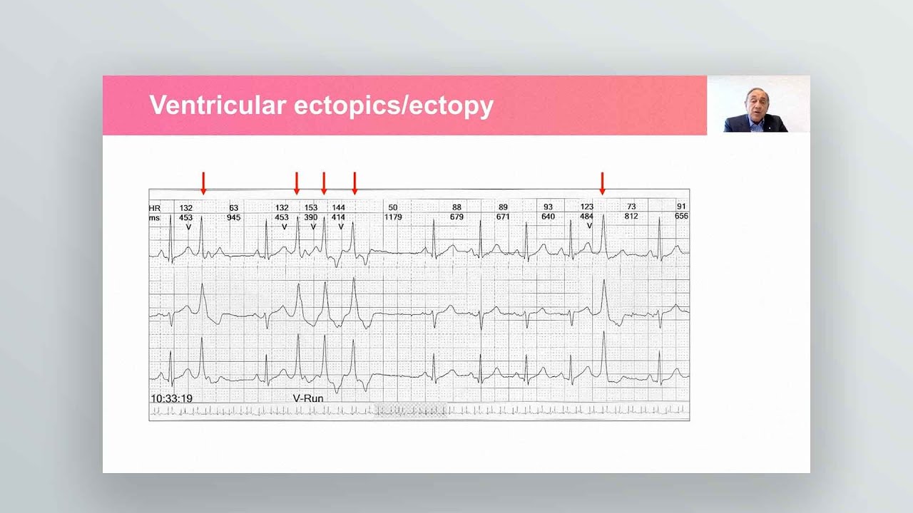 The Electrocardiographic Spectrum of Wenckebach Atrio-Ventricular Block ...