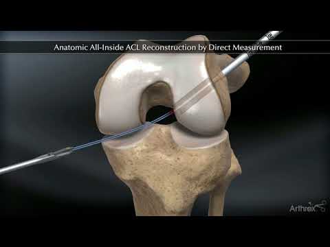 Anatomic All-Inside ACL Reconstruction by Direct Measurement - YouTube