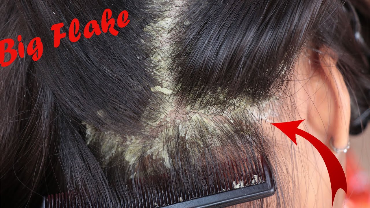 Dandruff Combing On Right Side!! Dandruff Removal Satisfying #639 - YouTube