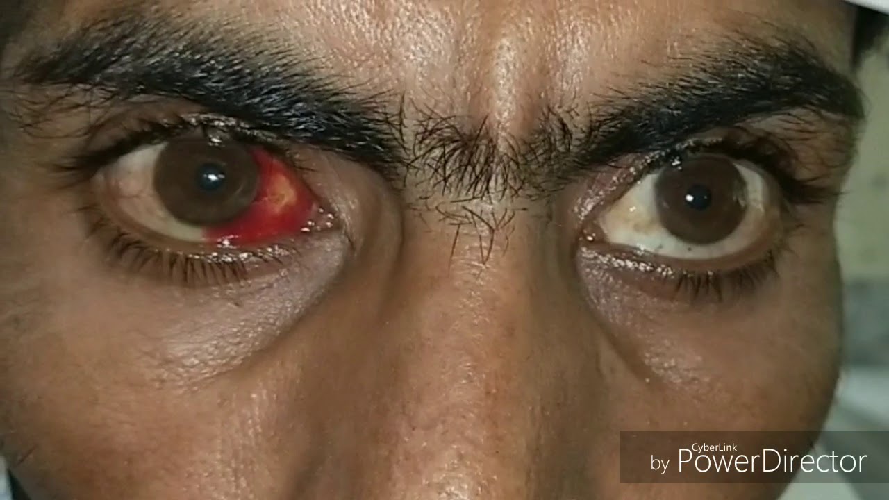 Subconjunctival haemorrhage - YouTube